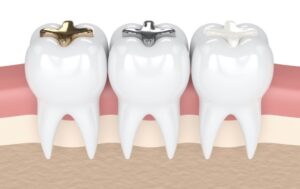 Dental Filling | Hornsby Dentist | Hornsby Dental
